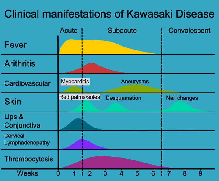Kawasaki Disease – Pearls and Pitfalls – Paediatric Foam