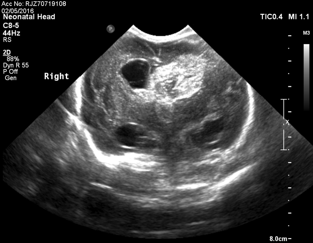 Ultrasound Criteria For The Diagnosis Of Hydrocephalus