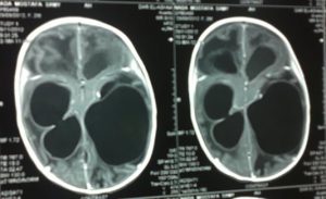 Bleeds and Blockages: Post-Haemorrhagic Hydrocephalus – PaediatricFOAM