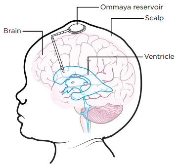 Bleeds and Blockages: Post-Haemorrhagic Hydrocephalus – PaediatricFOAM
