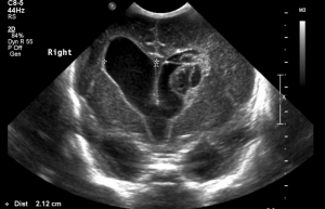 Bleeds and Blockages: Post-Haemorrhagic Hydrocephalus – PaediatricFOAM