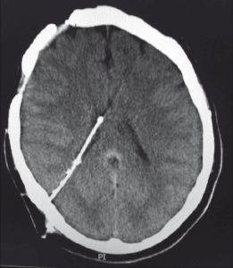 Bleeds and Blockages: Post-Haemorrhagic Hydrocephalus – PaediatricFOAM