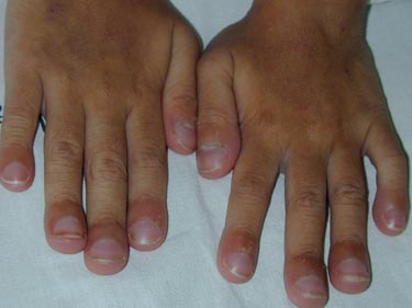 clubb – PaediatricFOAM